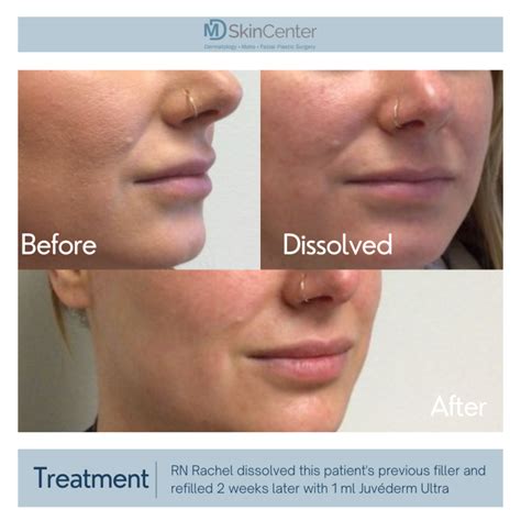 Juvéderm By Md Skincenter In Rockford