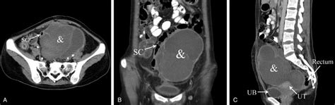 A C At 25 Days Postoperatively A Ct Scan Shows That The Placenta