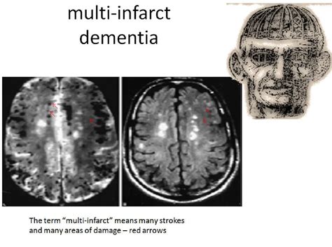 Multi Infarct Dementia Life Expectancy