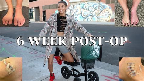Ankle Surgery 6 Week Post Brostrom Ankle Surgery Update Youtube