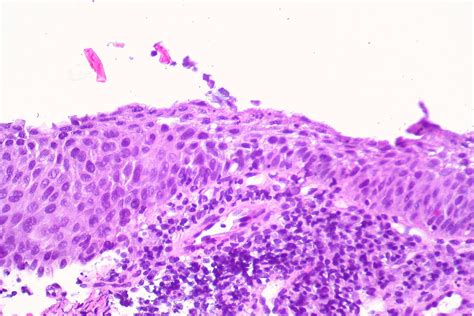 Cervical Biopsy 400x This Is The Only One Of The Four Spe… Flickr