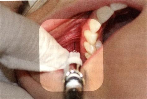 Chapter 11 And 12 Basic Injection Techniques And Maxillary Injections Flashcards Quizlet