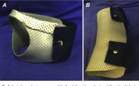 Figure 1 From Dart Splint An Innovative Orthosis That Can Be Integrated Into A Scapho Lunate