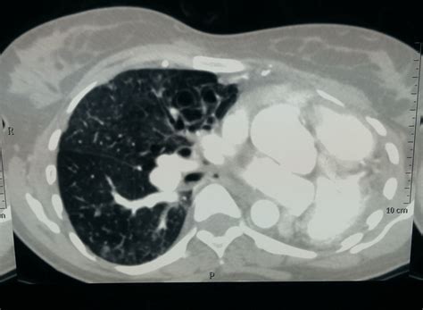 Cect Showing Pulmonary Agenesis Download Scientific Diagram