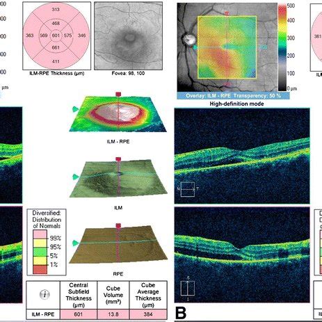 Improvement Of SRF In The Left Eye Of A Patient With Chronic CSCR Is Download Scientific