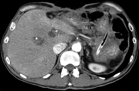 Computer Tomography Scan After Splenectomy And Distal Pancreatectomy