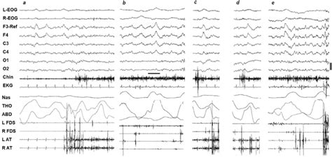C Atypical K Complexes In Poorly Structured N2 P S N2 Atypical K