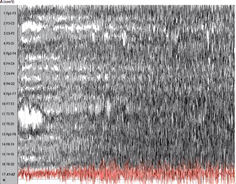 Primary Generalized Tonic Clonic Seizures Neupsy Key