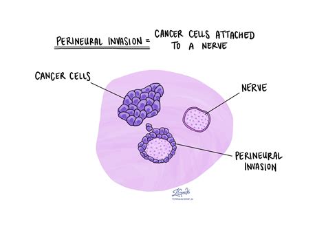 What Does Perineural Invasion Mean Mypathologyreport Ca