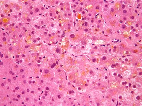 Intrahepatic Cholestasis Of Pregnancy Ross Lab Hot Sex Picture