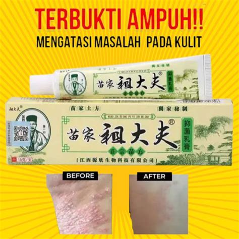 Jual Salep Gatal Jerawat Obat Gatal Kulit Paling Ampuh Selangkangan