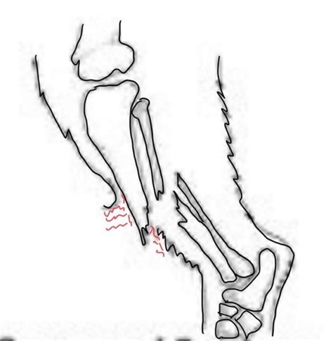Fractures Flashcards Quizlet