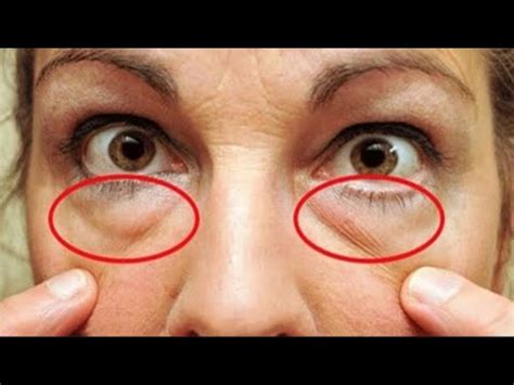 Cómo quitar las bolsas de los ojos en 20 minutos Belleza y Autoestima