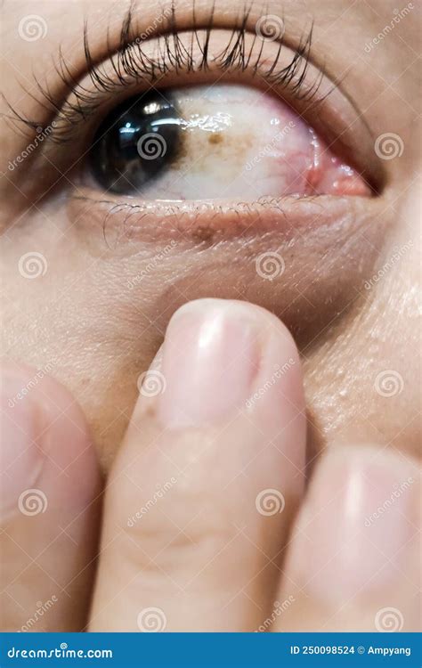 Eye Conjunctiva And Sclera Stock Image 220382497