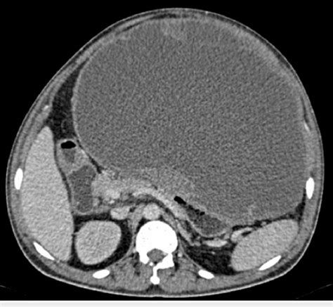Cect Axial Image Showing The Large Solid Cystic Lesion In Relation To