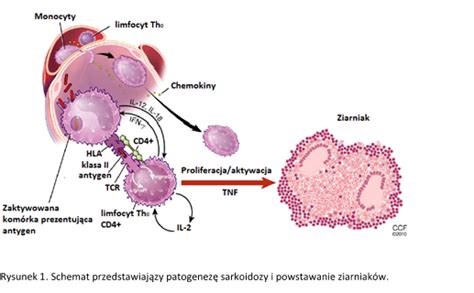 Sarkoidoza BioInf