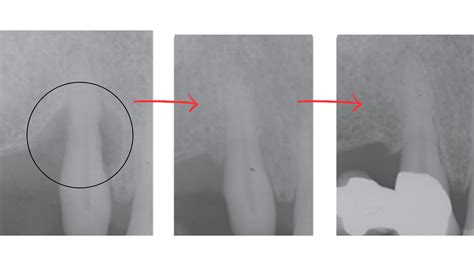 Periodontal Bone Grafting A Regenerative Approach For Gum Disease