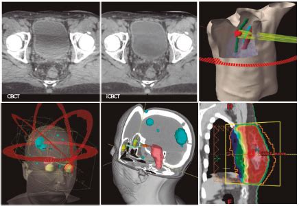 Radioterapia Conformada 3D Tratamentos CORB Radioterapia