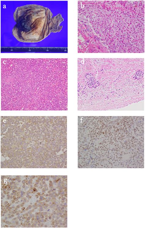 Pathological Analysis Of The Gallbladder Carcinoma A Macroscopic