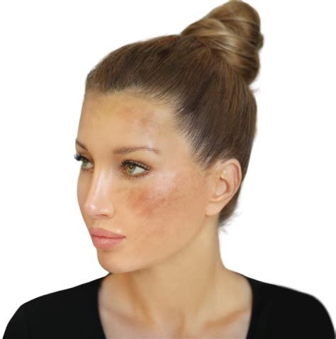 Melasma Treatment Nesc Aesthetics