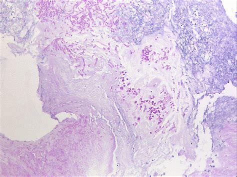 Fungal Spores And Pseudohyphae In The External Iliac Artery Periodic Download Scientific
