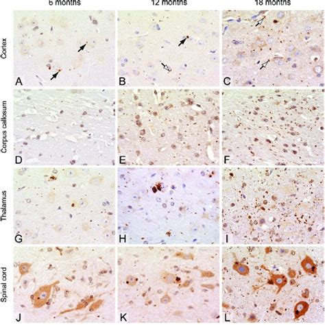 P62 Positive Inclusions In Brain And Spinal Cord Of Chmp2b Intron 5