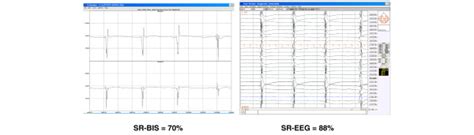 Burst Suppression Pattern With Short Duration Bursts In Patient 3 The