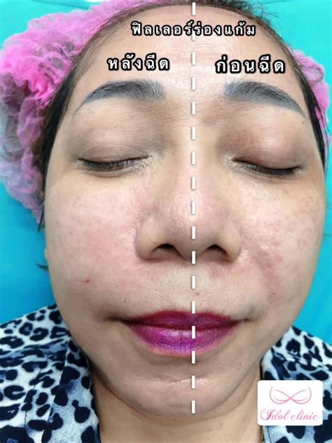 Review Filler 💥 เติมเต็มร่องแก้ม 💥 ไร้ร่องลึก 💥 หน้าดูอ่อนกว่าวัย