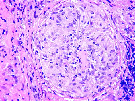 Sarcoidosis Apoptotic Bodies Pyknotic Nuclei Of Epitheli Flickr