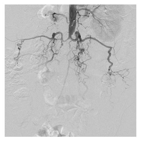 Aortogram Showing Total Occlusion Of The Distal Abdominal Aorta And
