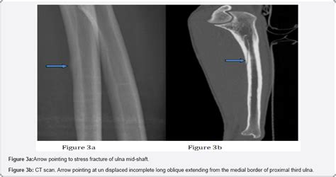 Ulna Hairline Fracture