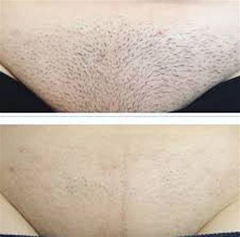 Có Nên Tẩy Lông Vùng Kín Hội Dược Học Tphcm