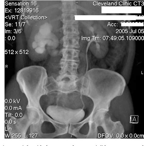 Figure 1 From Laparoscopic Dismembered Pyeloplasty Of A Retrocaval