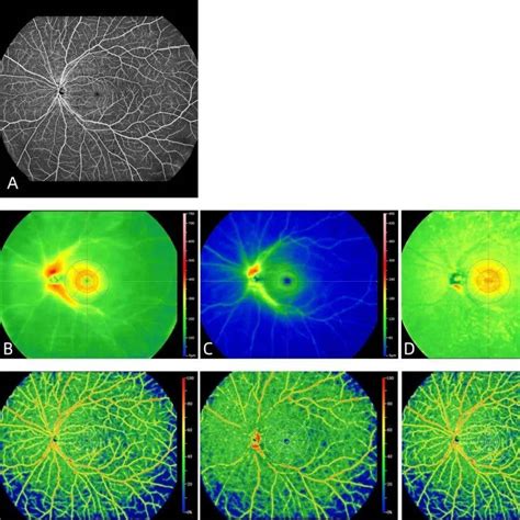超广角octa量化功能再发新作视网膜密度研究