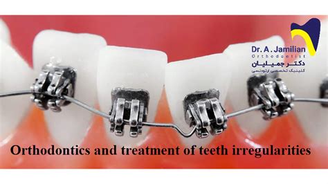 Orthodontics And Treatment Of Teeth Irregularities Dr Jamilian