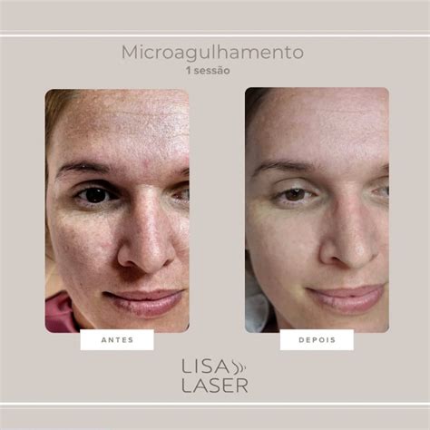 Microagulhamento Vantagens E Cuidados Pós Procedimento