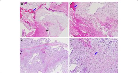Histopathology Of Patient 1s Specimen Hematoxylin And Eosin Stain
