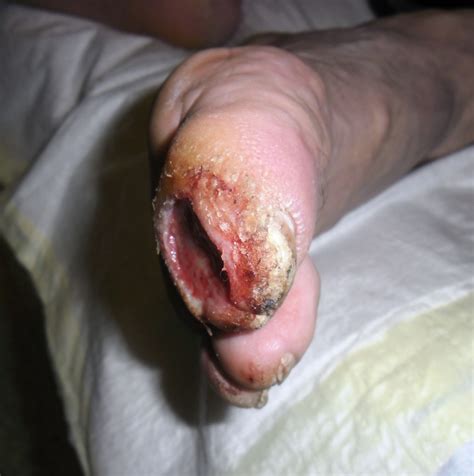 Hyperkeratosis Big Toe With Ulcer Doccheck