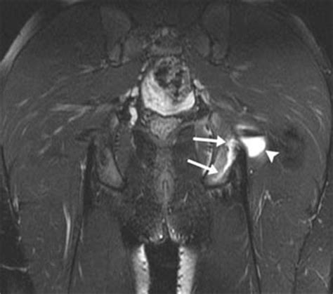 Hamstring Tears Radsource