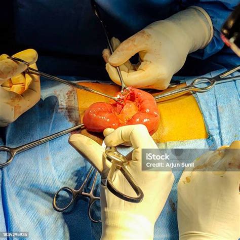 Doctors Doing Exploratory Laparotomy Surgery In A Patient With