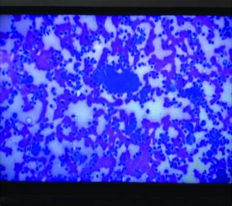 Raspberry Like Tumor On The Skin A Rare Entity Journal Of Skin And Sexually Transmitted Diseases