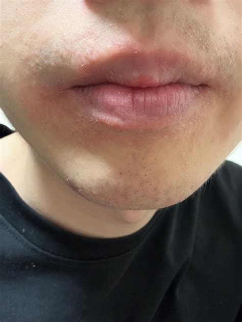 입 주변 두드러기피부염 지식in