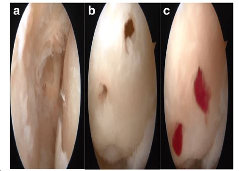 A Chondral Defect B Chondral Surface After The Microhole Drill C Download Scientific Diagram