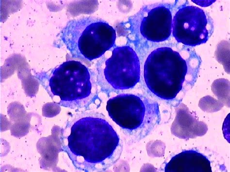 Bone Marrow Biopsy Wright Stain × 1000 Showed 76 5 Undifferentiated