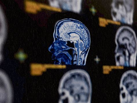 Brain Embolism Definition Symptoms Treatment And More