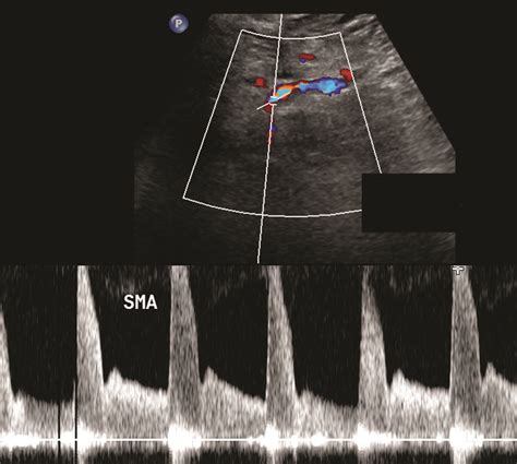 Chronic Mesenteric Ischemia Mesenteric Artery Duplex Sonography And