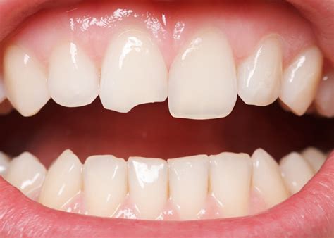 Cracked Tooth Dental Treatments Abroad Dental Clinic Heraklion Crete