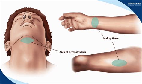 Microvascular Free Flap Reconstruction Surgery For Head And Neck Cancer