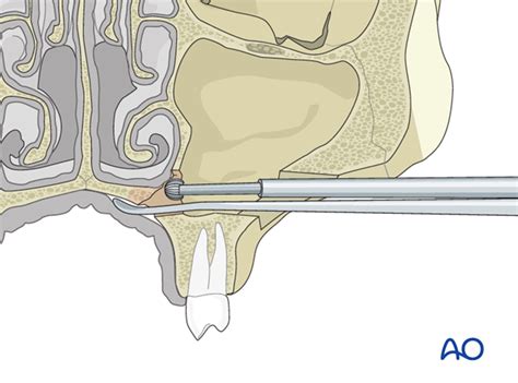 Subapical Block Osteotomy For Mandibular Alveolar Protrusion