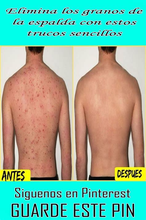 Elimina Los Granos De La Espalda Con Estos Trucos Sencillos ESPALDA